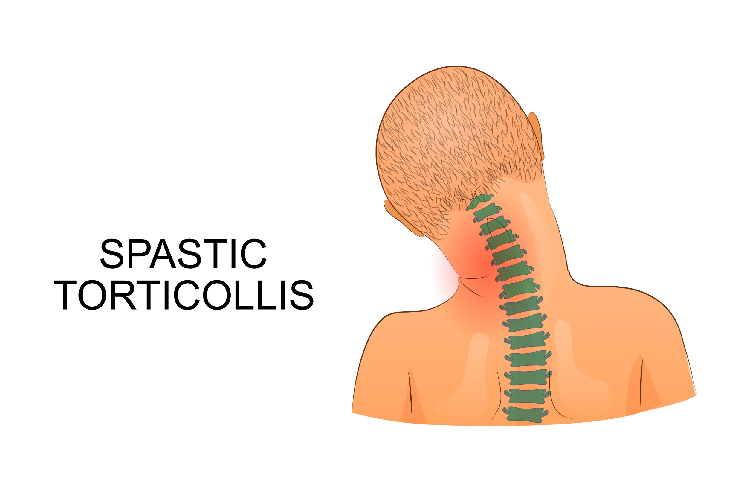 TORTICOLIS FEBRILE DE L’ENFANT & SYNDROME DE GRISEL - esculape
